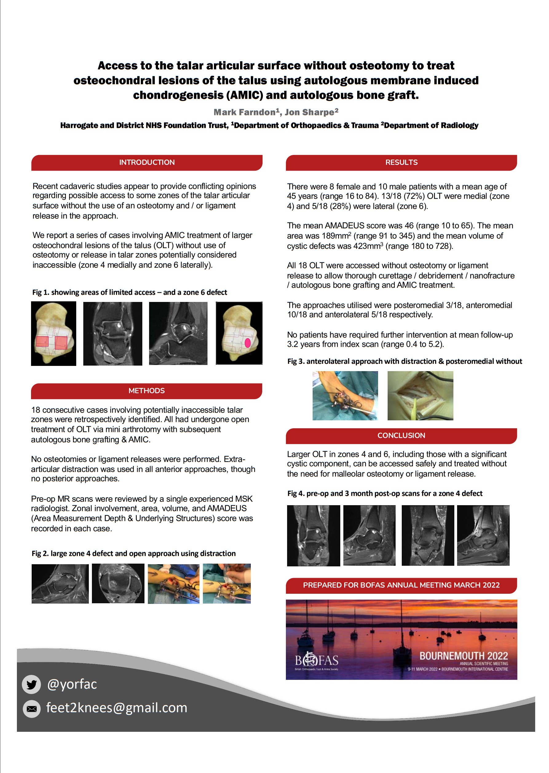 Access to the talar articular surface without osteotomy to treat osteochondral lesions of the ...