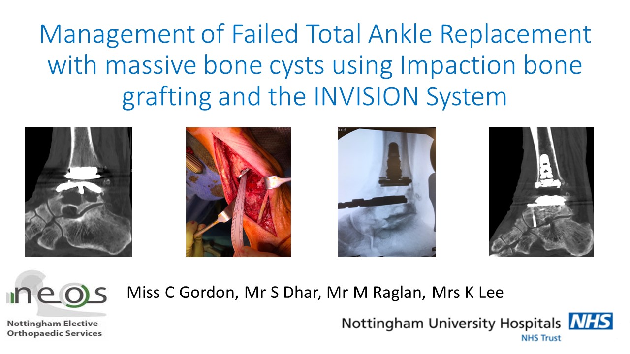 Management of failed total ankle replacement and massive bone cysts ...