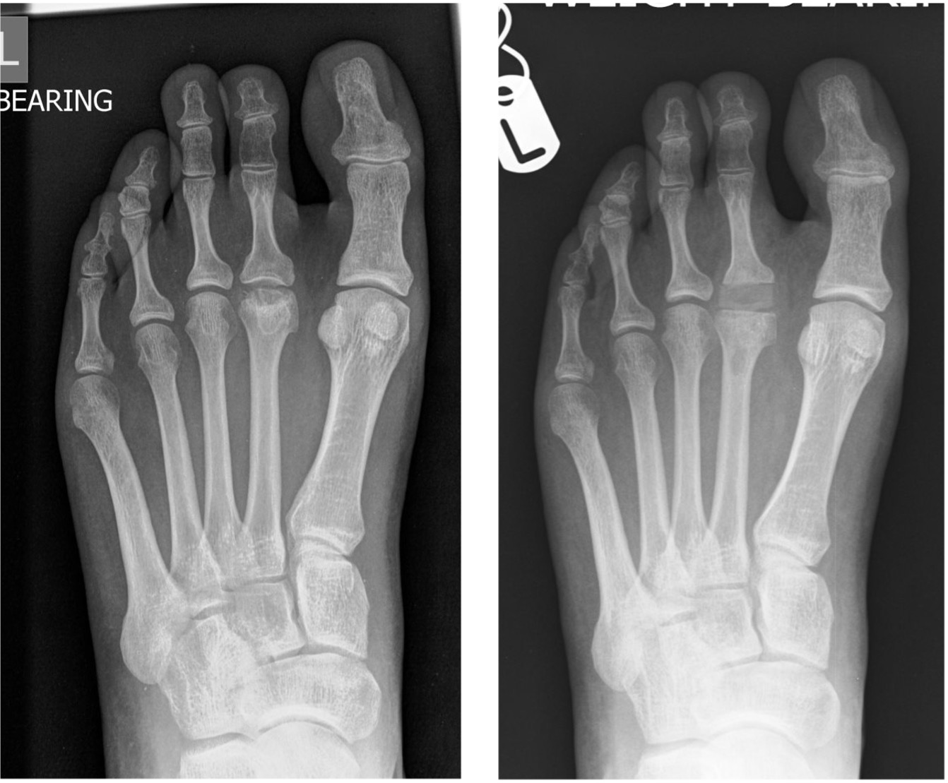 BOFAS > Hyperbook > Forefoot > Freiberg's Disease