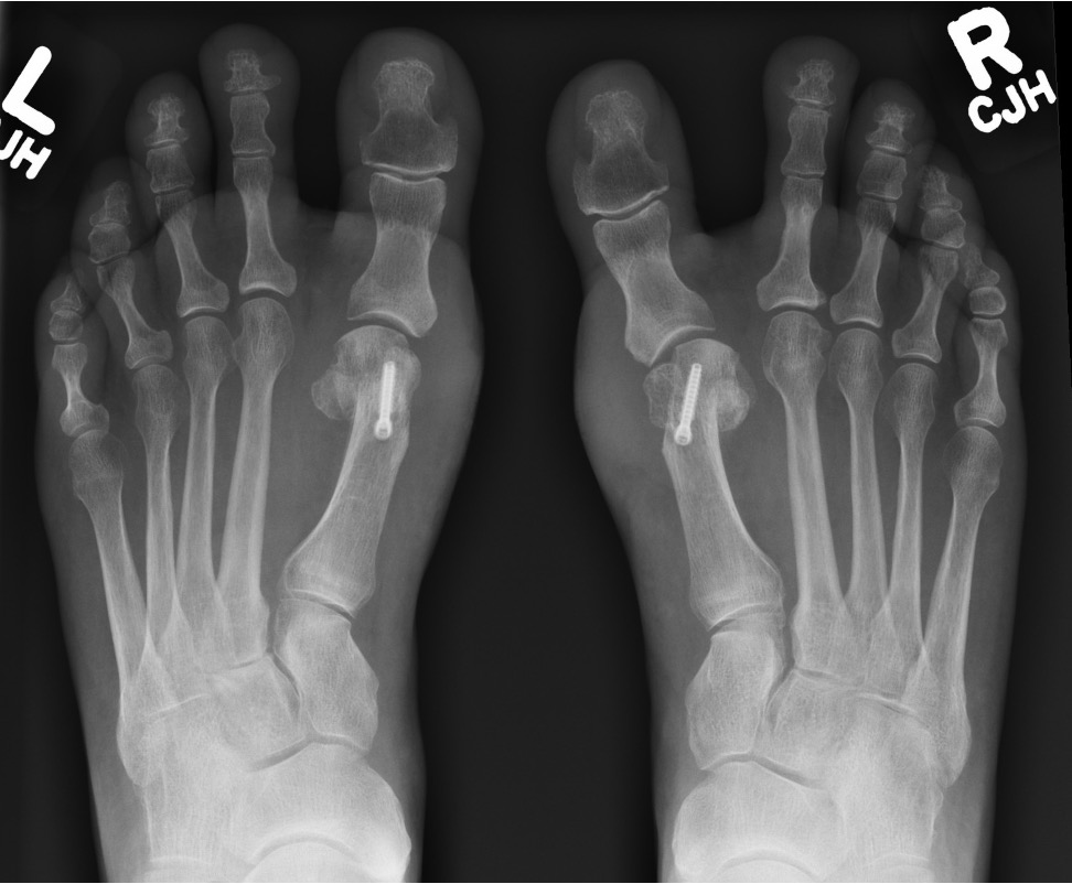 BOFAS > Hyperbook > Forefoot > Hallux Varus