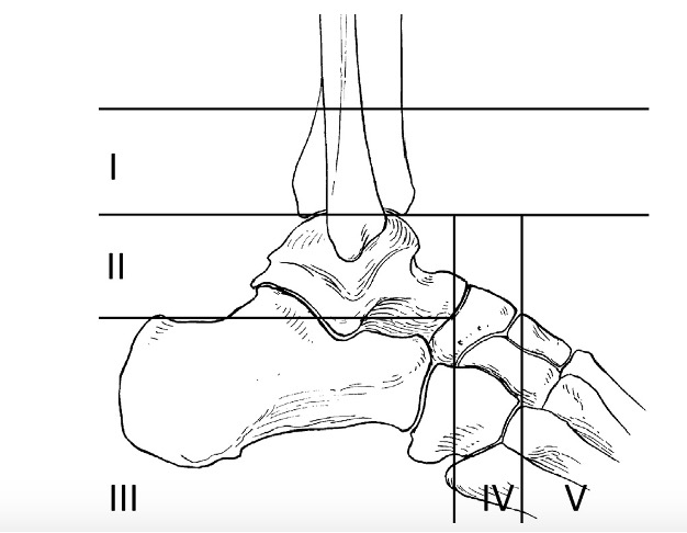 BOFAS > Hyperbook > Trauma > Crushed Foot