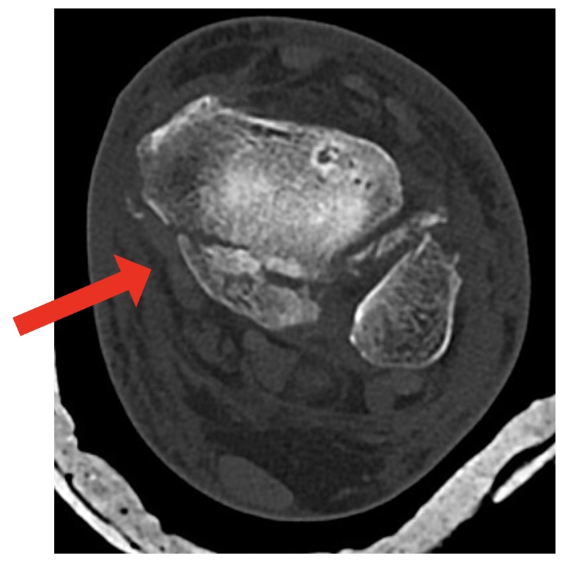 BOFAS > Hyperbook > Trauma > Ankle Fractures > Posterior malleolus