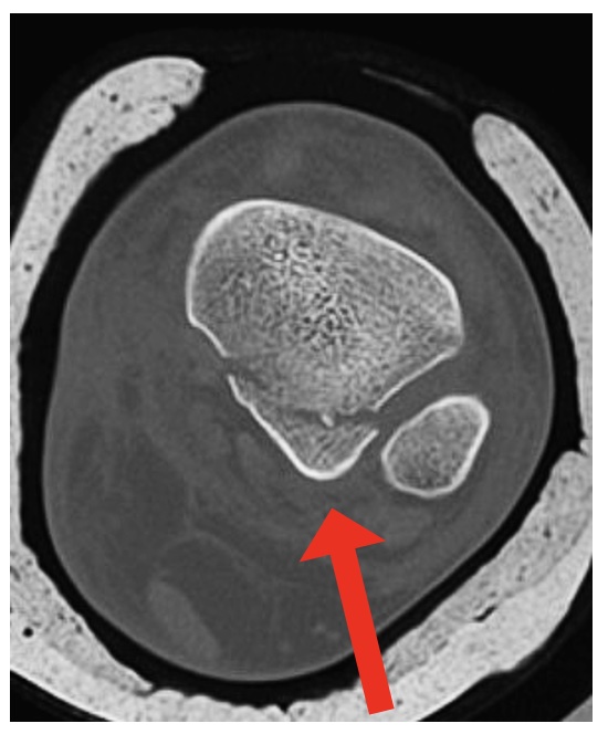 BOFAS > Hyperbook > Trauma > Ankle Fractures > Posterior malleolus