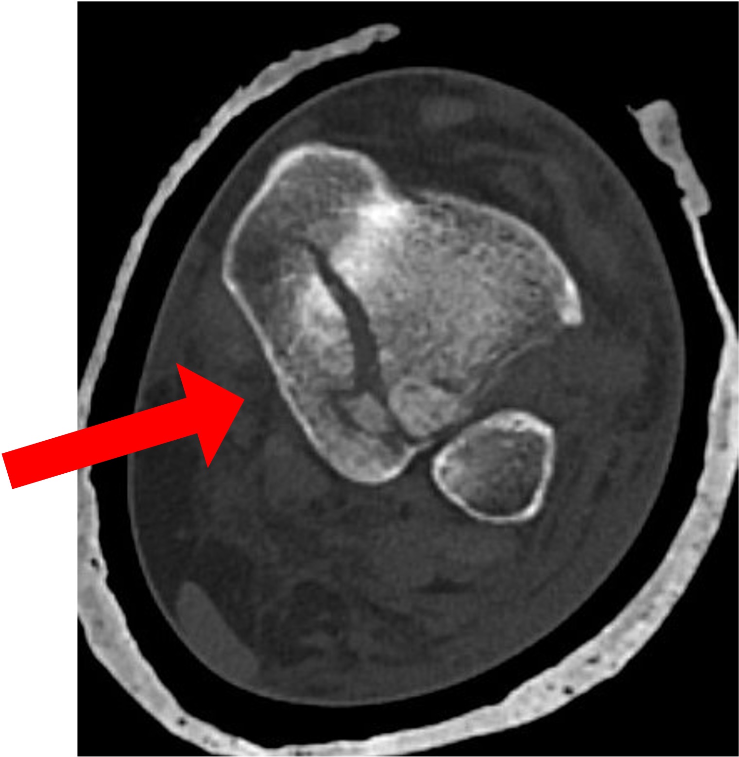BOFAS > Hyperbook > Trauma > Ankle Fractures > Posterior malleolus