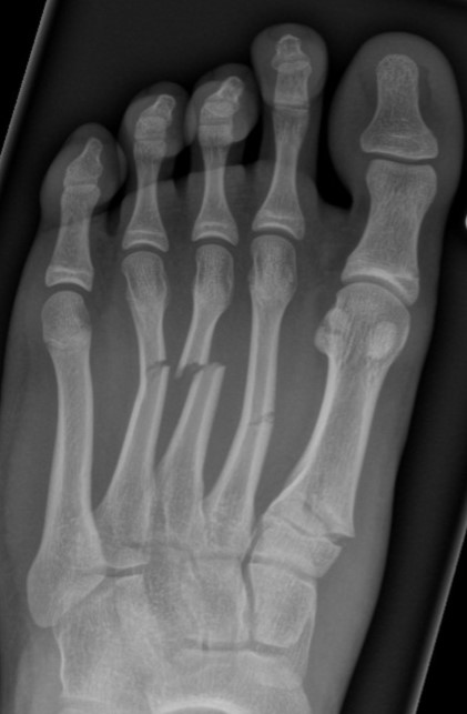 BOFAS > Hyperbook > Trauma > Metatarsal Fractures