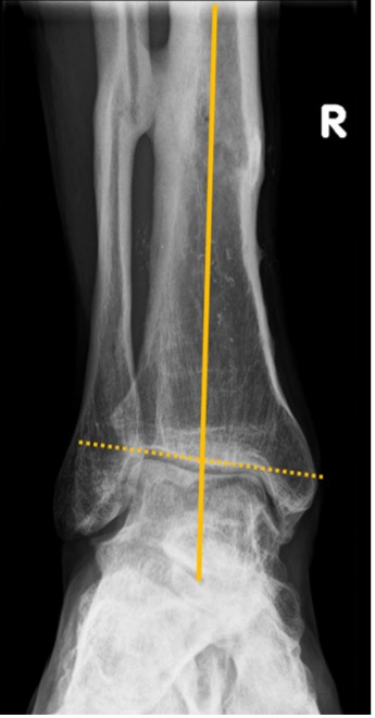 BOFAS > Hyperbook > Ankle > Ankle Arthritis > Osteotomies Around the Ankle