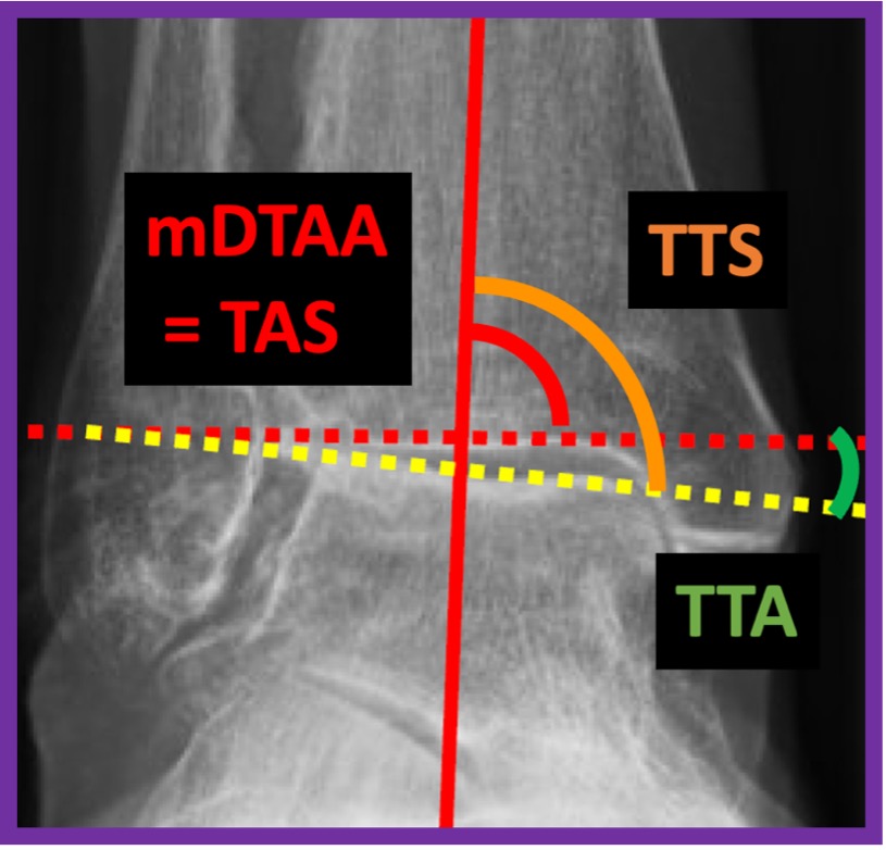 BOFAS > Hyperbook > Ankle > Ankle Arthritis > Osteotomies Around the Ankle