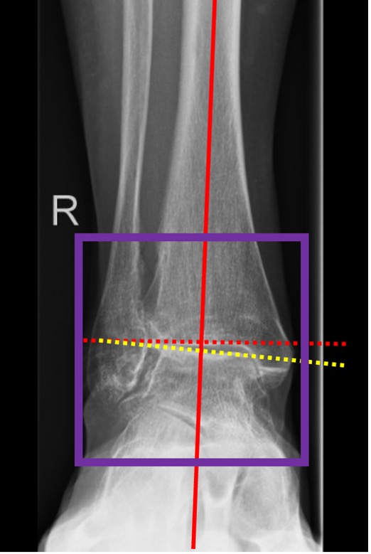 BOFAS > Hyperbook > Ankle > Ankle Arthritis > Osteotomies Around the Ankle