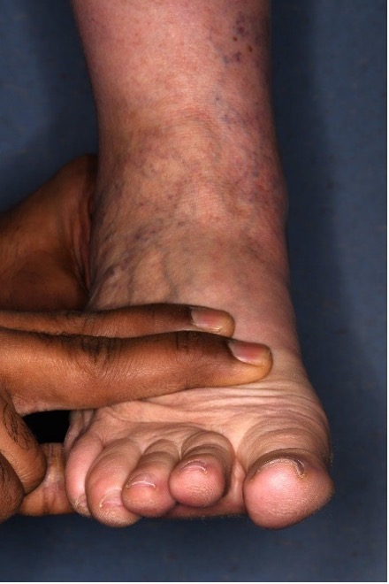 BOFAS > Hyperbook > Mid & hindfoot > Pes Planus