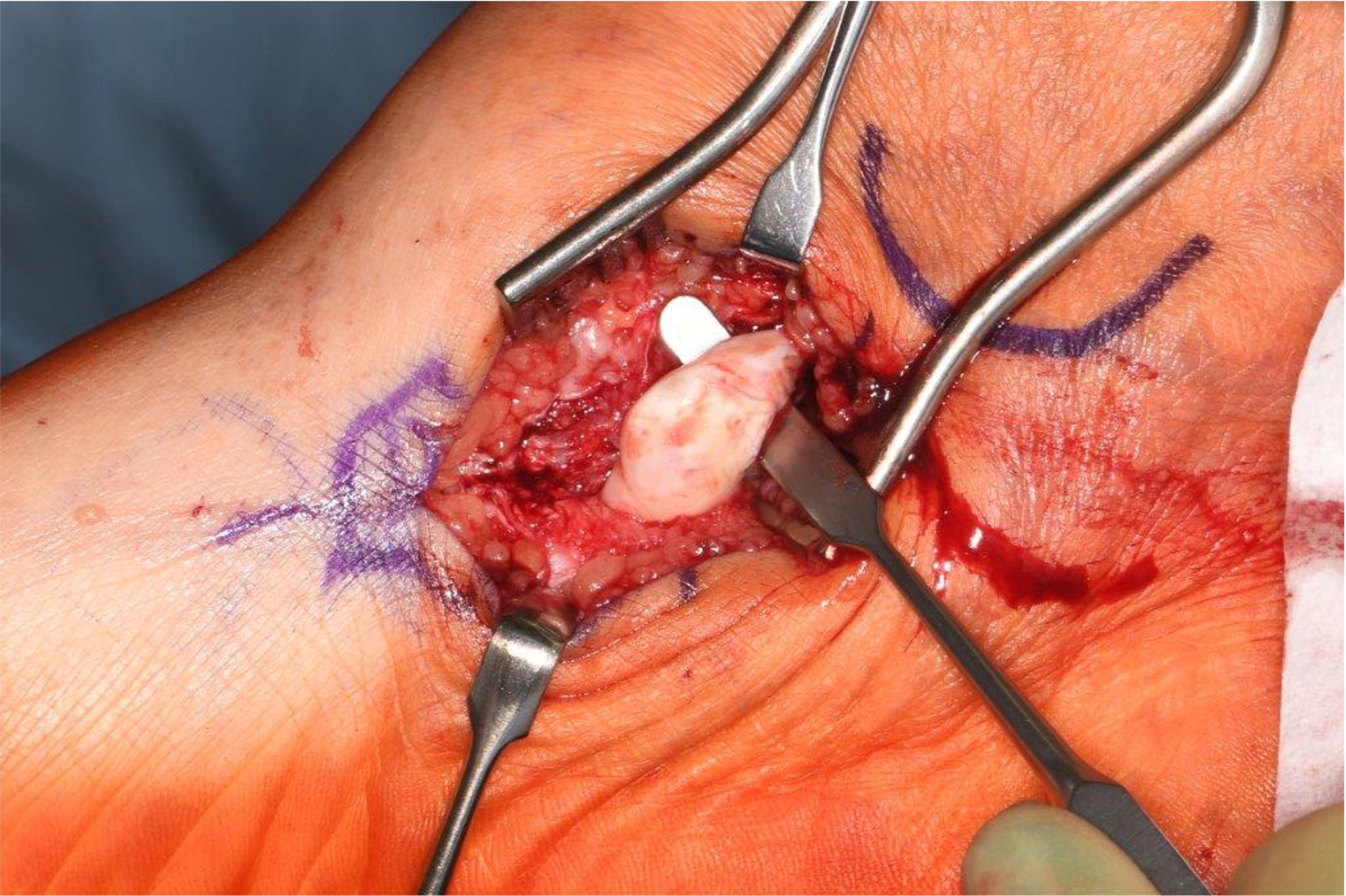 BOFAS > Hyperbook > Mid & hindfoot > Pes Planus