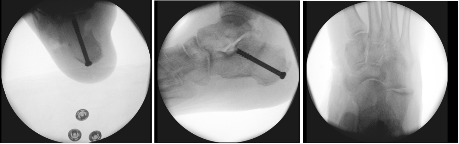 BOFAS > Hyperbook > Mid & hindfoot > Pes Planus