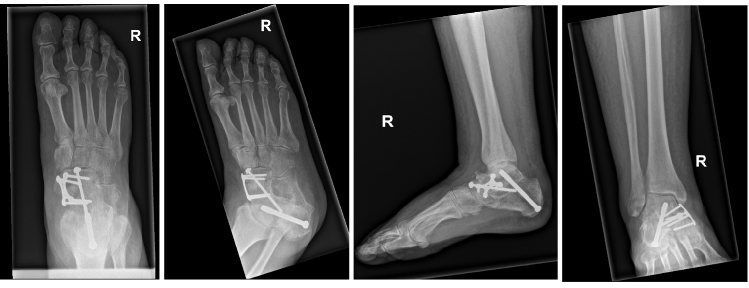 BOFAS > Hyperbook > Mid & hindfoot > Pes Planus