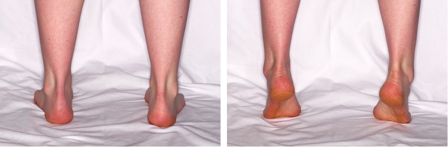 BOFAS > Hyperbook > Midfoot & Hindfoot Disorders > Pes Planus