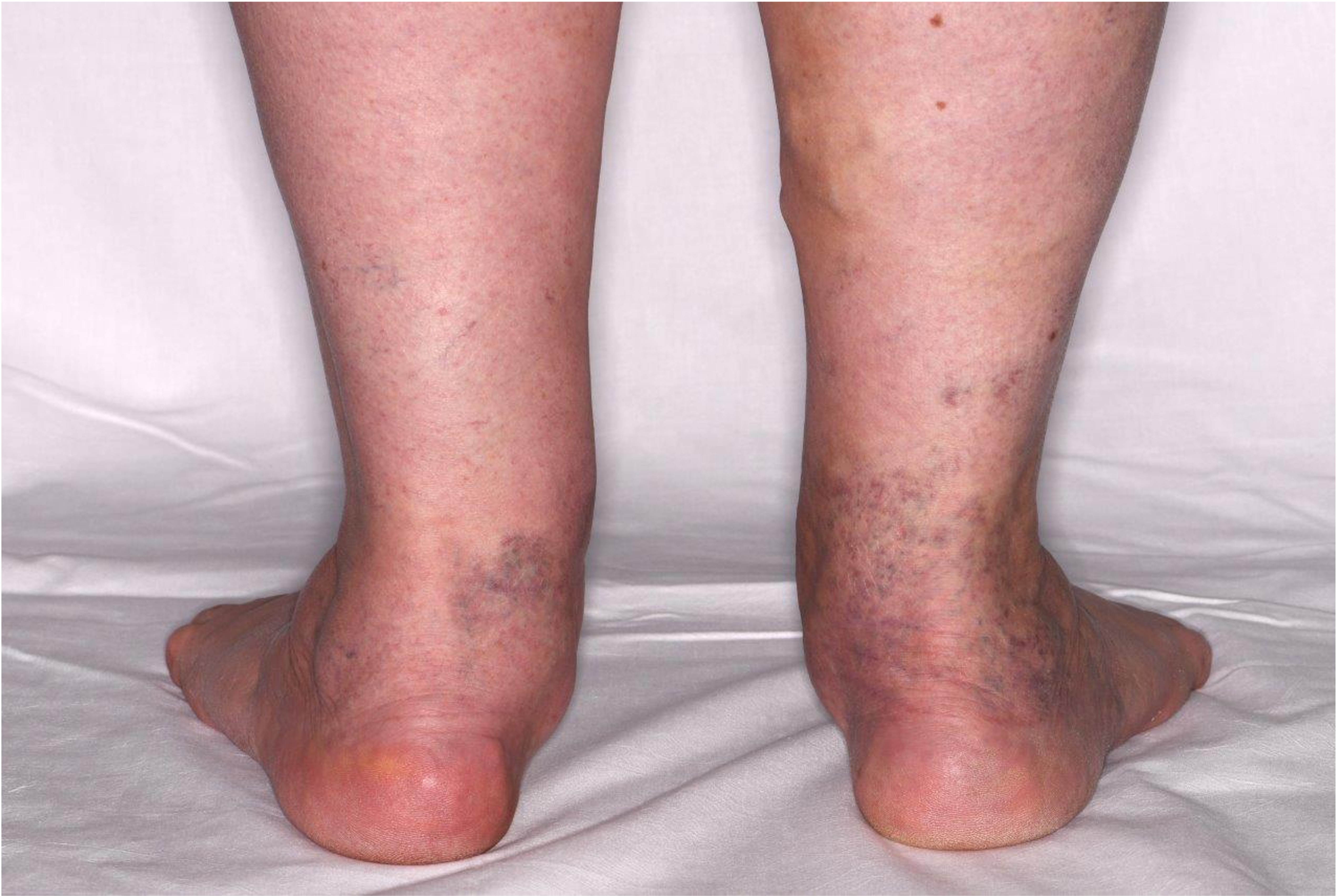 BOFAS > Hyperbook > Mid & hindfoot > Pes Planus