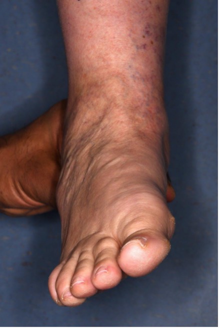 BOFAS > Hyperbook > Mid & hindfoot > Pes Planus
