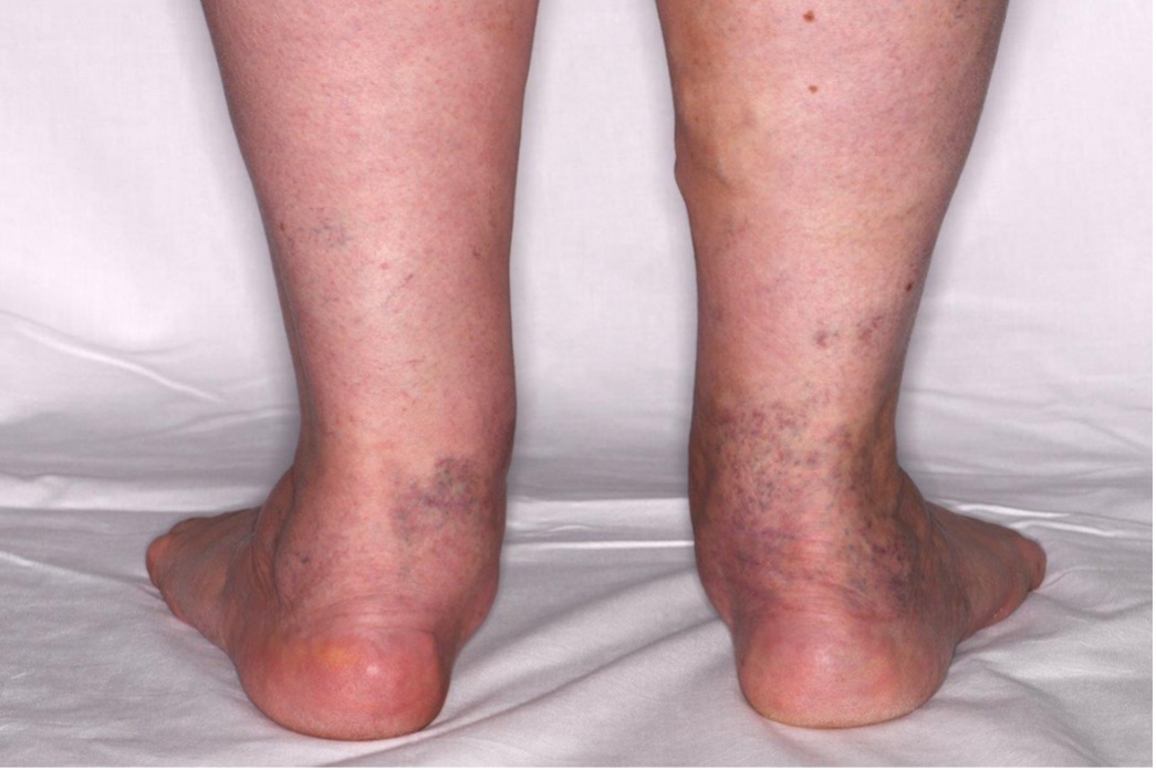 BOFAS > Hyperbook > Mid & hindfoot > Pes Planus