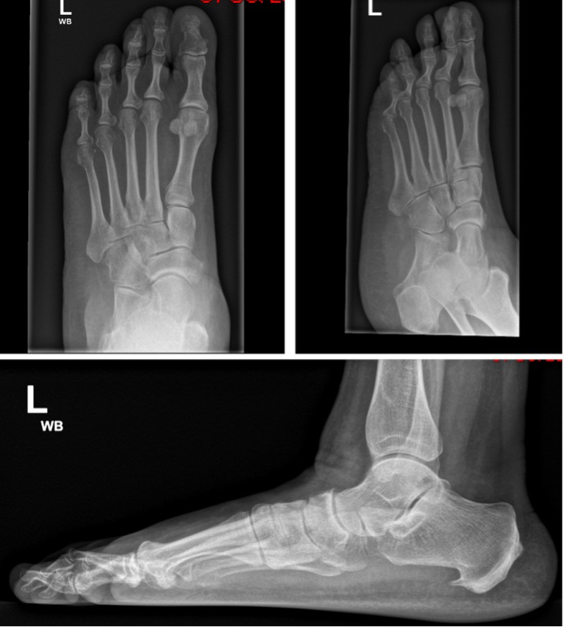 BOFAS > Hyperbook > Mid & hindfoot > Pes Planus