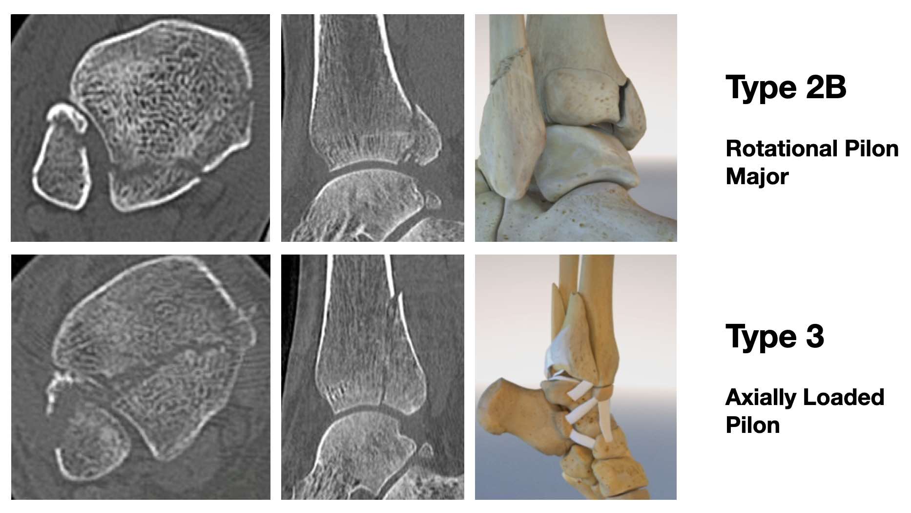 BOFAS > Hyperbook > Trauma > Ankle Fracture > Posterior malleolus