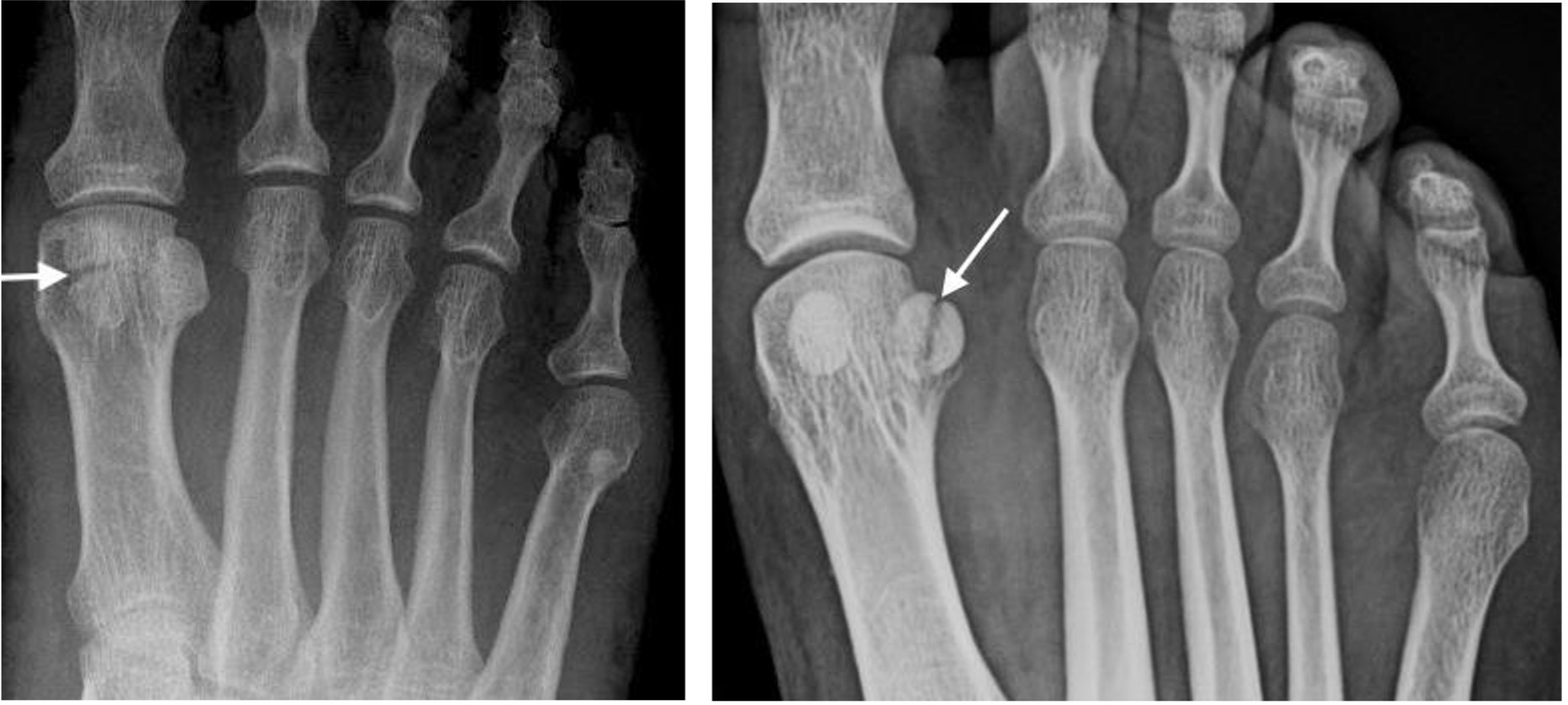 BOFAS > Hyperbook > Radiology > 3. Anatomical Variation