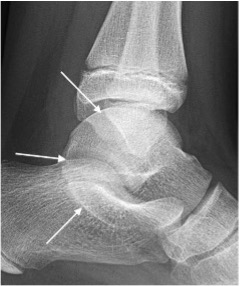 BOFAS > Hyperbook > Radiology > 3. Anatomical Variation