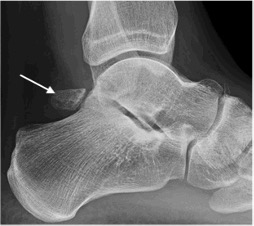 BOFAS > Hyperbook > Radiology > 3. Anatomical Variation