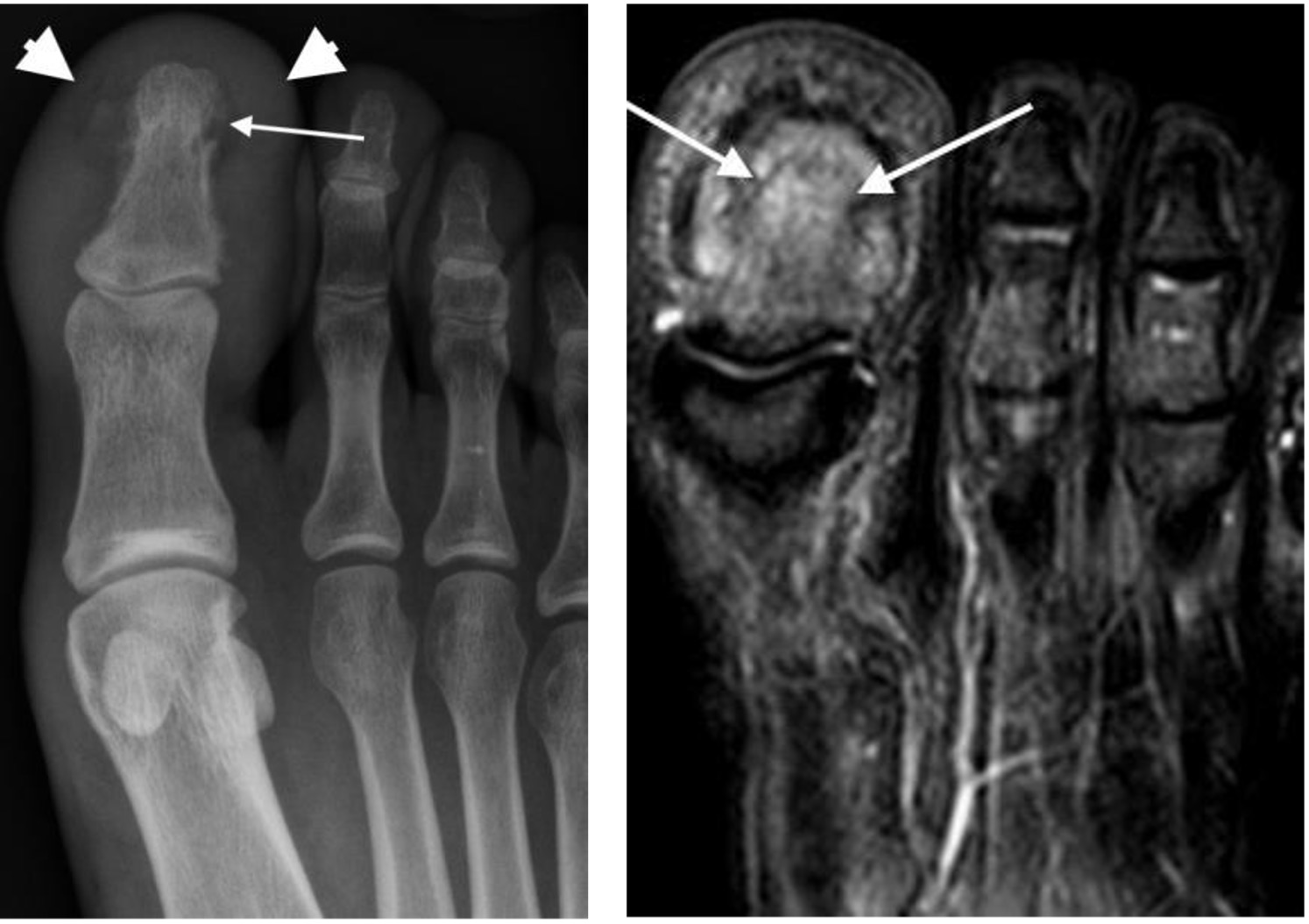 BOFAS > Hyperbook > Radiology > 4. Bone Pathology
