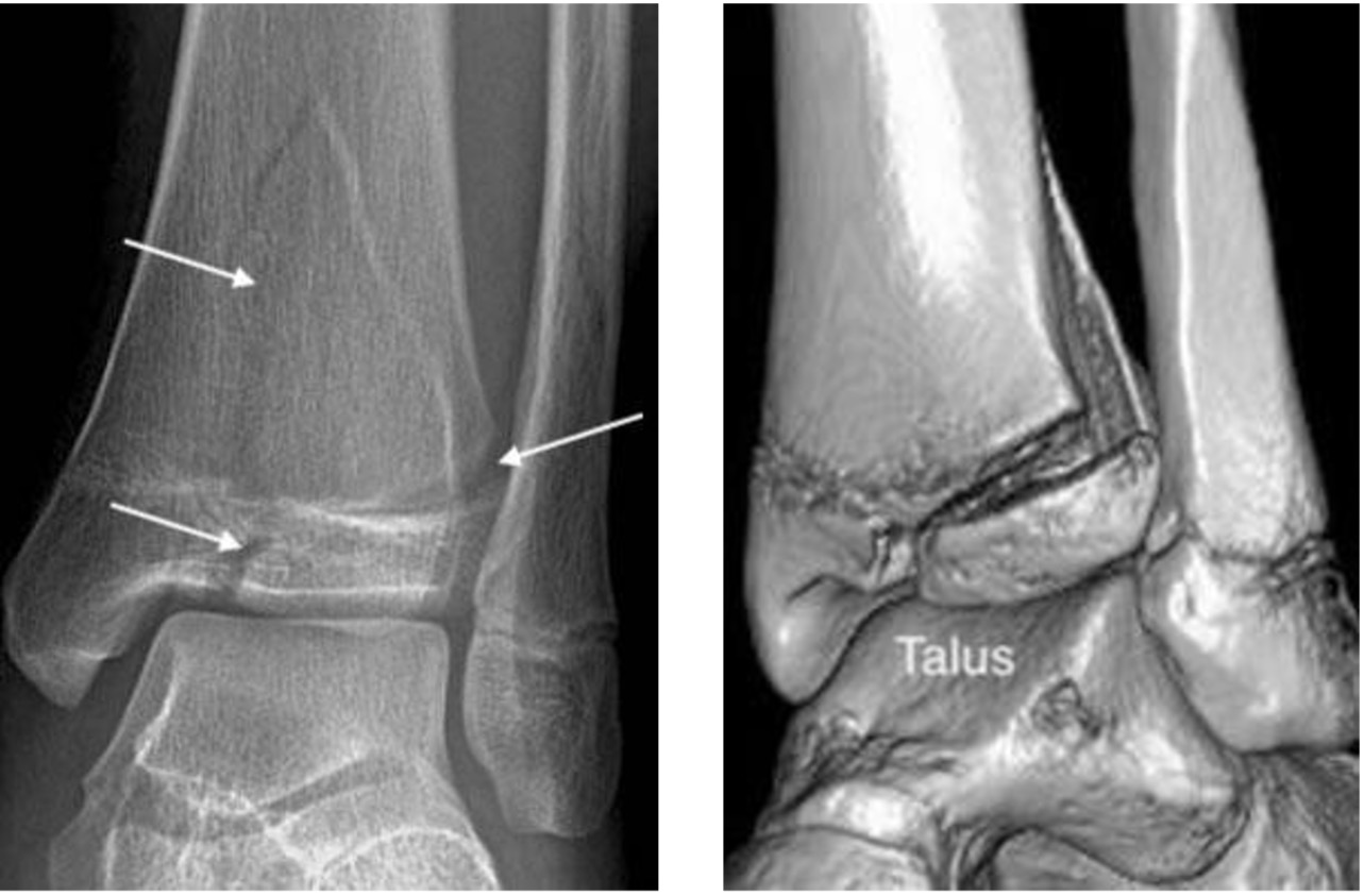 Talus Fracture Mri