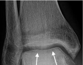 BOFAS > Hyperbook > Radiology > 5. Fractures