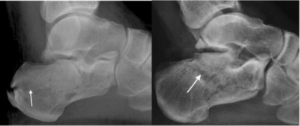 BOFAS > Hyperbook > Radiology > 5. Fractures