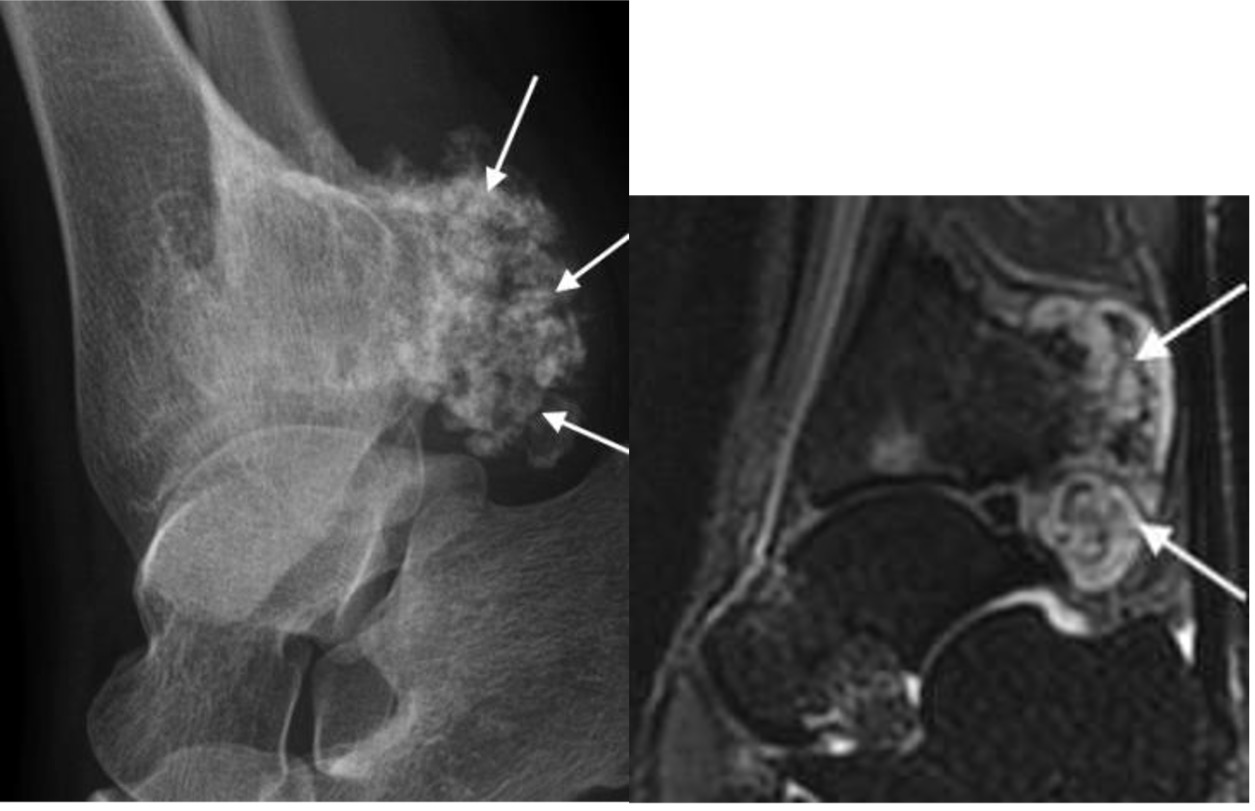 BOFAS > Hyperbook > Radiology > 6. Bone Tumours