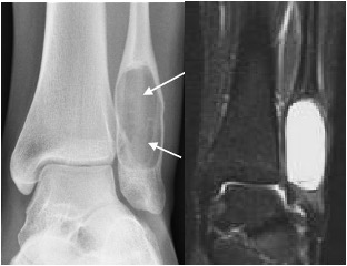 BOFAS > Hyperbook > Radiology > 6. Bone Tumours