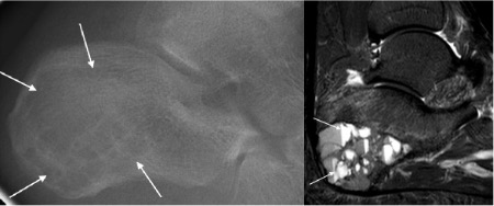 BOFAS > Hyperbook > Radiology > 6. Bone Tumours