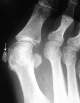 BOFAS > Hyperbook > Radiology > 8. Joint and Soft Tissue Pathology