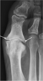 BOFAS > Hyperbook > Radiology > 8. Joint and Soft Tissue Pathology