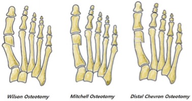 BOFAS > Hyperbook > Forefoot Disorders > Hallux Valgus > Scarf vs ...