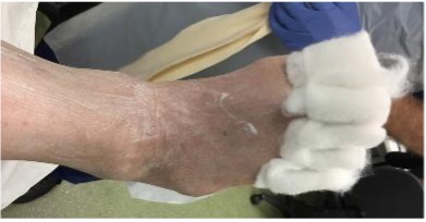 BOFAS > Hyperbook > Systemic > Diabetic Foot > Total Contact Casting