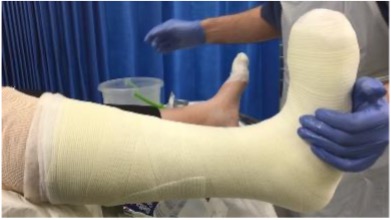 BOFAS > Hyperbook > Systemic > Diabetic Foot > Total Contact Casting