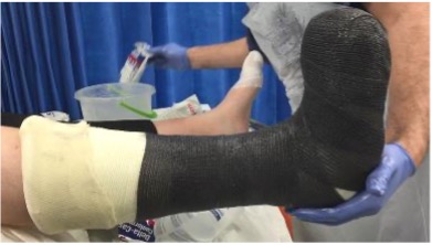 BOFAS > Hyperbook > Systemic > Diabetic Foot > Total Contact Casting