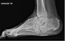 BOFAS > Hyperbook > Systemic > Diabetic Foot > Acute Diabetic Foot