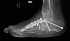 BOFAS > Hyperbook > Systemic > Diabetic Foot > Acute Diabetic Foot